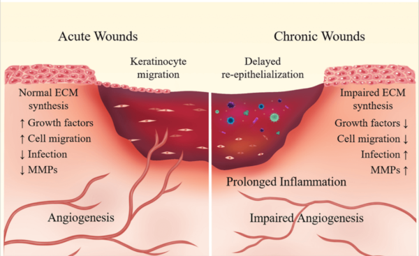 Acute vs Chronic Wounds - DFW Wound Care Center - Wound Care Doctor Acute vs Chronic Wounds - DFW Wound Care Center - Wound Care Doctor